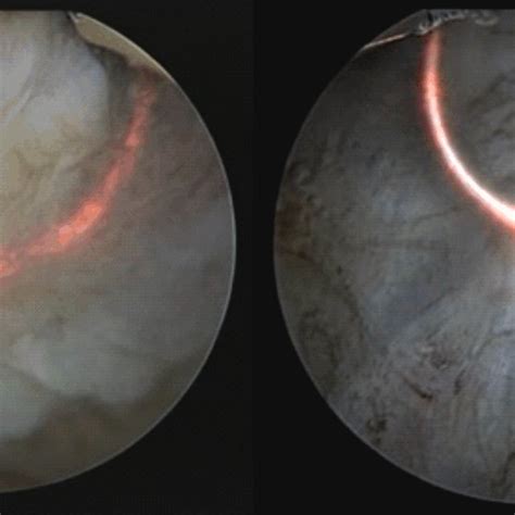 Tumor Base Bipolar Single Wire Loop Resection Biopsy Download