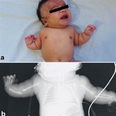 1a Infants Face With No Dysmorphic Features 1b Extremity Anomalies