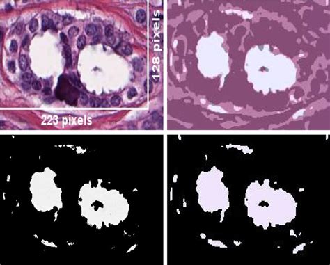 Segmentation Of A Breast Tissue In The Second Row We Have Shown The Download Scientific