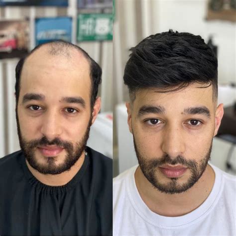 Hair Systems Before And After Toupee Hairstyle