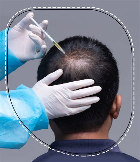 Prp Therapy