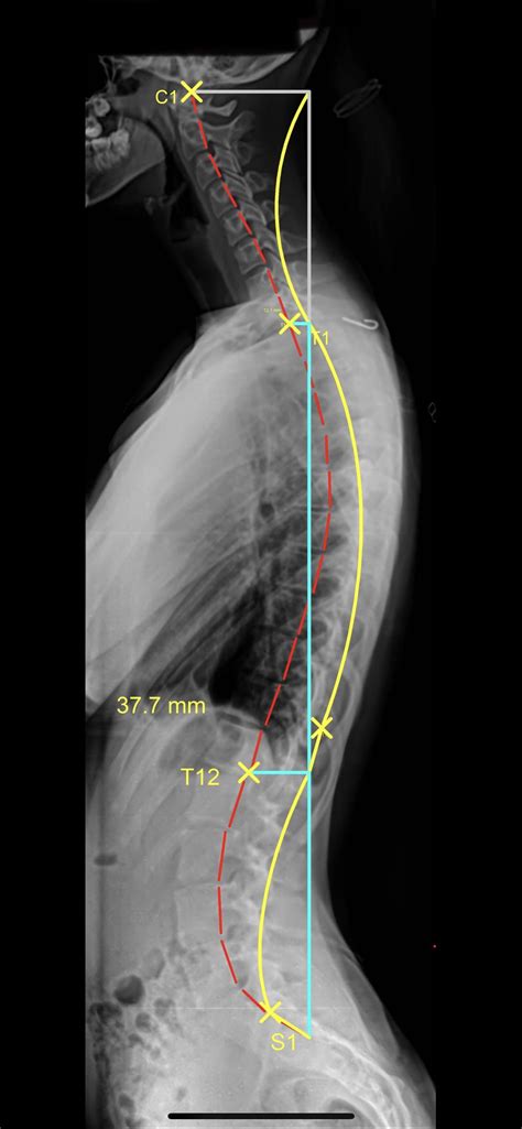 Forward Head Posture X Ray Military Neck