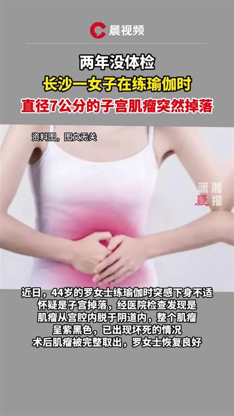 警惕！女子两年没体检，在练习瑜伽时子宫肌瘤突然掉落 凤凰网视频 凤凰网