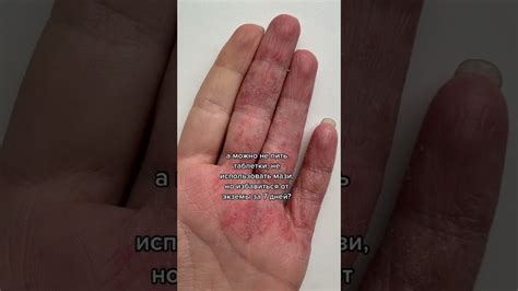 Экзема причины симптомы лечение фото мазь и диета при экземе