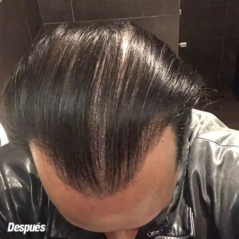 Trasplante de Cabello Dr Pereyra Restauración Capilar