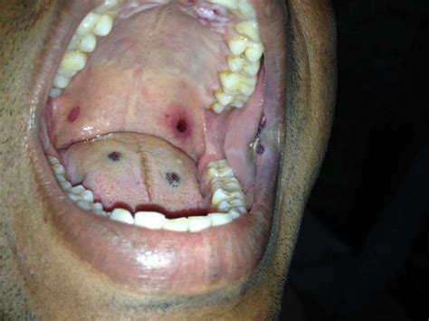 Erythema Multiforme By Aseem