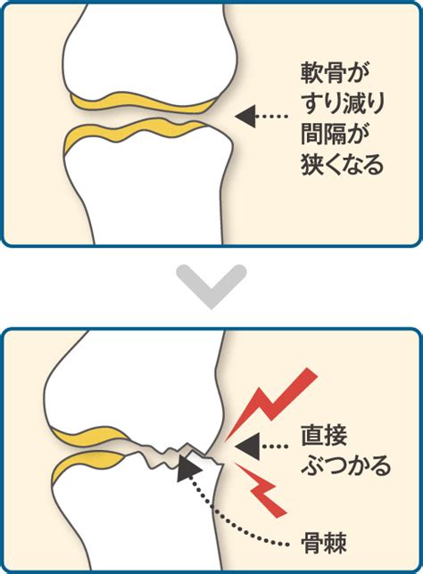 膝装具 関節炎の痛み 変形性関節症アンローダー調整可能なrom安定化膝左のサポート 変形性関節症