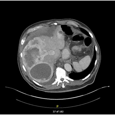 Computed Tomography Scan Revealing Extensive Hepatic Metastases