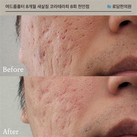 로담한의원 얼굴패인흉터 새살침 코라테라피 여드름흉터 치료결과는 로담한의원 여드름흉터