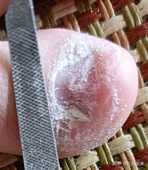 冰醋酸和碘酒哪个治疗灰指甲好
