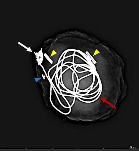 Case Vascular Abnormalities Radiology Ucla Health