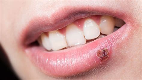 Blister On Lips Home Remedy
