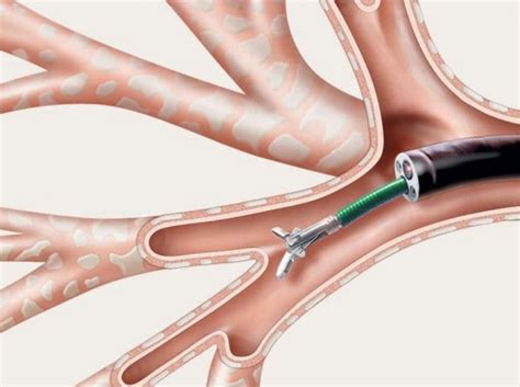 Biopsia pulmonar Qué es Centro de Cirugía de Vía Aérea