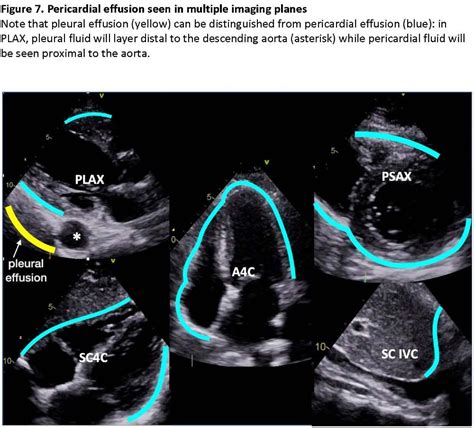 Pocus Spotlight Focused Cardiac Ultrasonography