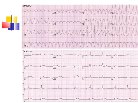 Ecg Interpretation Ppt