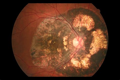 Bilateral Peripapillary Congenital Hypertrophy Of The Rpe Chrpe