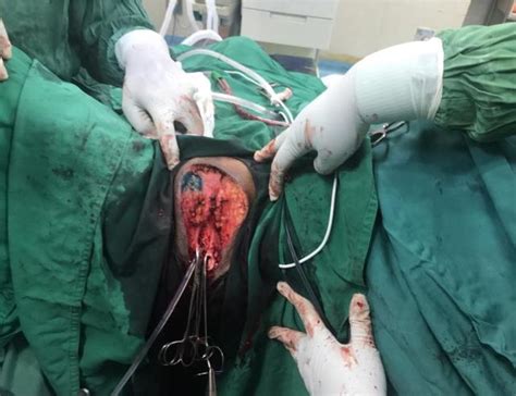 Figure 3 From Radical Vulvectomy For A Rare Case Of Squamous Cell Carcinoma Vulva A Case Report