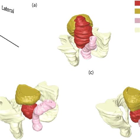 Reconstructed D Models Of Three Selected Patients From MRI Scans A