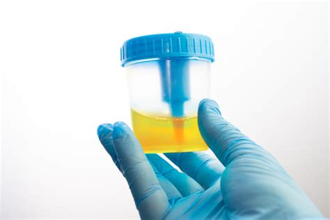 Urine Jaune Fluo Origines Et Comment Réagir News Santé