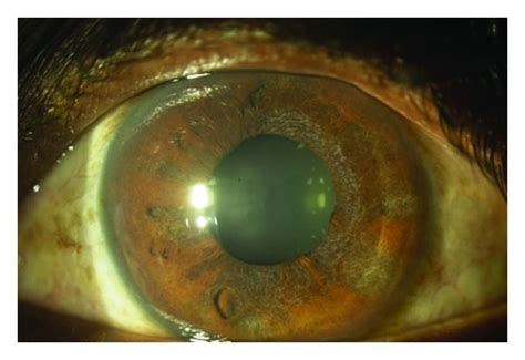 Right Eye Showing Iris Atrophic Patches Download Scientific Diagram