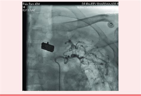 Source Of Bleeding From Left Bronchial Artery Download Scientific Diagram