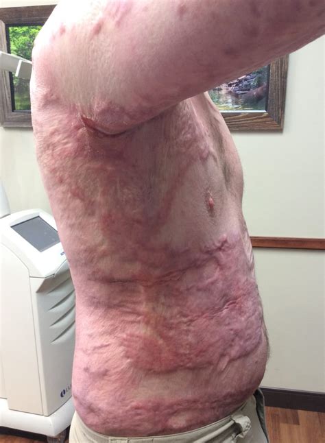 Laser Surgery Burn And Post Operative Scars Dermatologists Dr Hawley