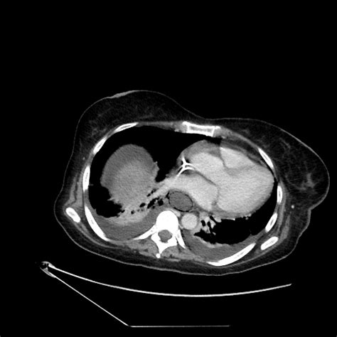 Fileesophageal And Gastric Pneumatosis Portal Venous Gas Radiopaedia