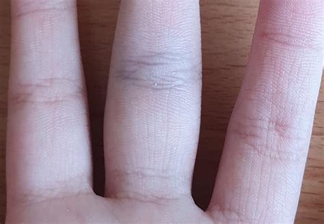 Guess Why My Finger Looks Like This Rteenagers