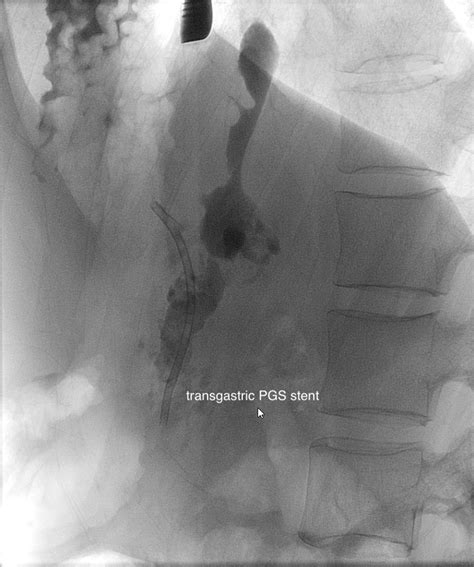 Endoscopic Rescue Therapy Of A Distally Perforated Retroperitoneal