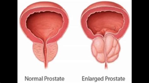 Urosurgery Surgical Notes For Gp Youtube