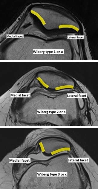 Wiberg Klassifikation Der Patellaform Pacs
