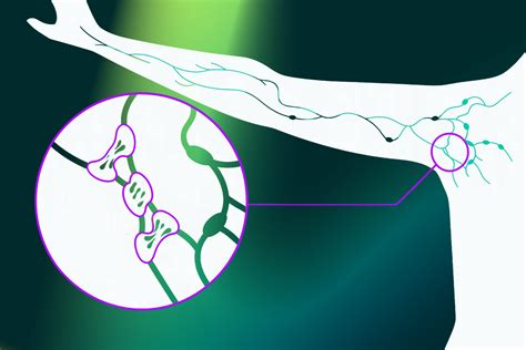 Axillary Cord Formation Also Known As Cording Or Axillary Web Syndrome
