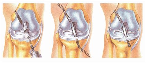 Best PCL Reconstruction Surgery In Delhi Dr L Tomar Dr L Tomar