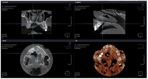 Oronasal Communication Cone Beam Computer Tomography Cbct Aspect Download Scientific Diagram