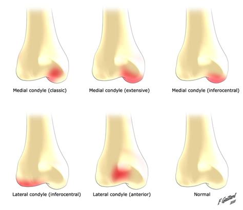 Osteochondritis Dissecans Of The Knee Pacs