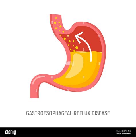 Gastroesophageal Reflux Disease Stomach GERD Heartburn Esophagus