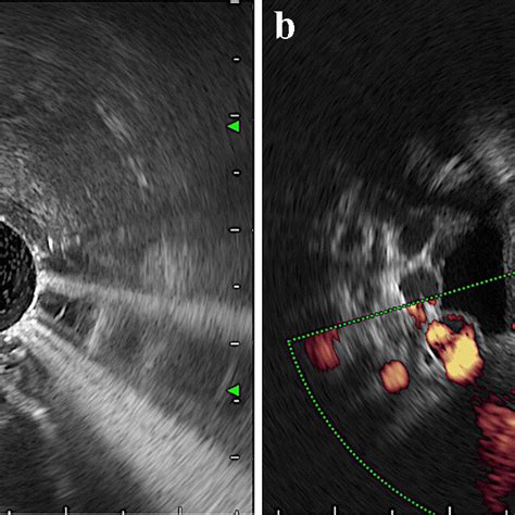 Endoscopic Ultrasound Eus In A Case With Symptomatic Portal Cavernoma