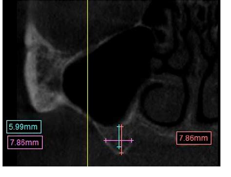 Figure 1 From Reliability Of Cone Beam Computed Tomography In Predicting Implant Treatment