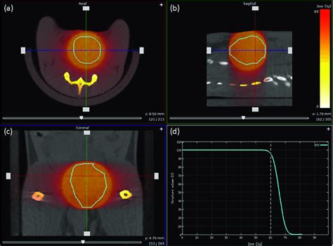 Dose Distribution And Dose Volume Histogram For Rx Of 60 Gy To 95 Of