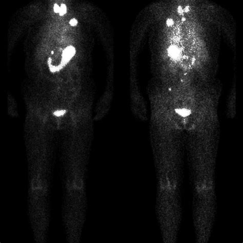Thyroid Static Imaging With 99mtco4− Showing A Nodule In The Middle