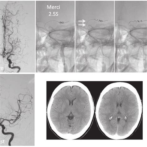 Analysis Of The Curve Angle Of The Horizontal Mca Segment M1 A M1 Download Scientific