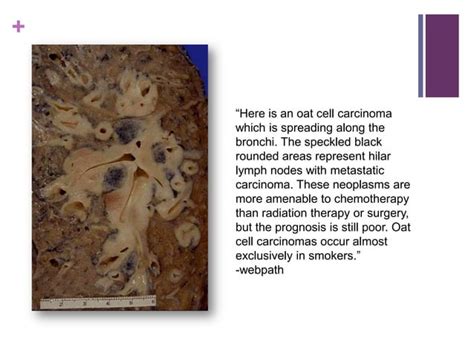 Lung Cancer Pathology And Clinical Pptx
