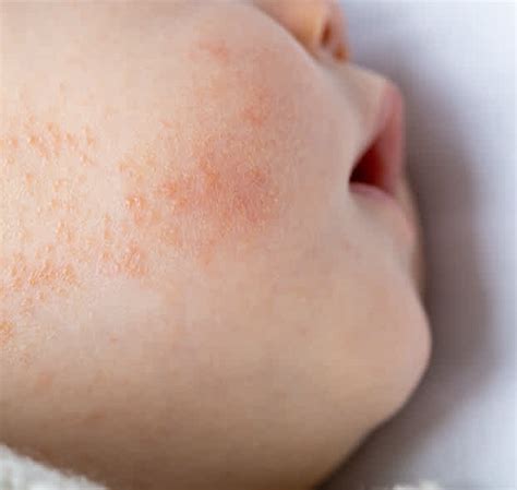 Piel Atópica En Bebés Cómo Cuidarla Pequeñín