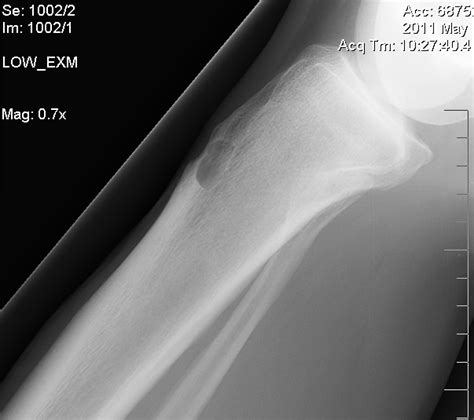 A 58 Year Old Man With A Right Proximal Tibia Lesion BoneTumor Org