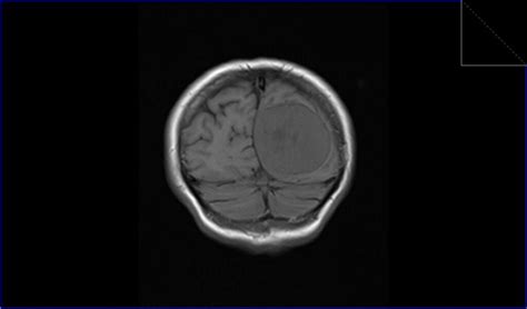 Meningioma Mri