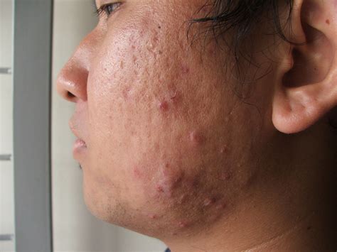 Difference Between Blackhead And A Pimple