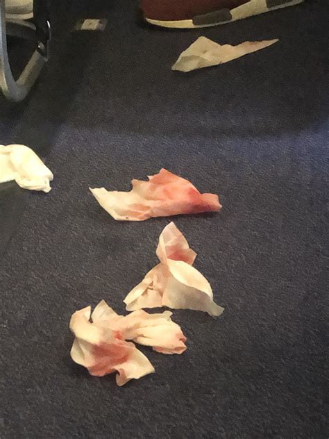Ryanair Passengers Face Was A Mess After Nose Was Bitten On