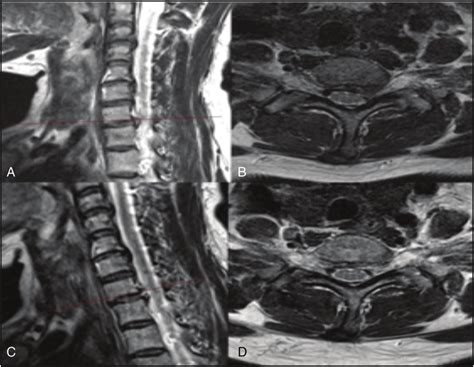 Preoperative A And B And Postoperative C And D Mri Of The Cervical