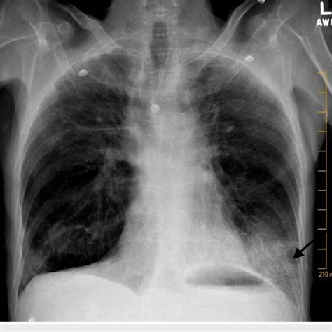 Chest X Ray Showing Left Lower Infiltrate Download Scientific Diagram