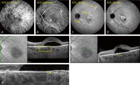 Images Showing The Left Eye Of A Patient With Csc With Mid Phase